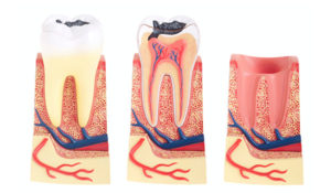 Socket Preservation | Carrollton Smiles | General Dentist in Carrollton TX